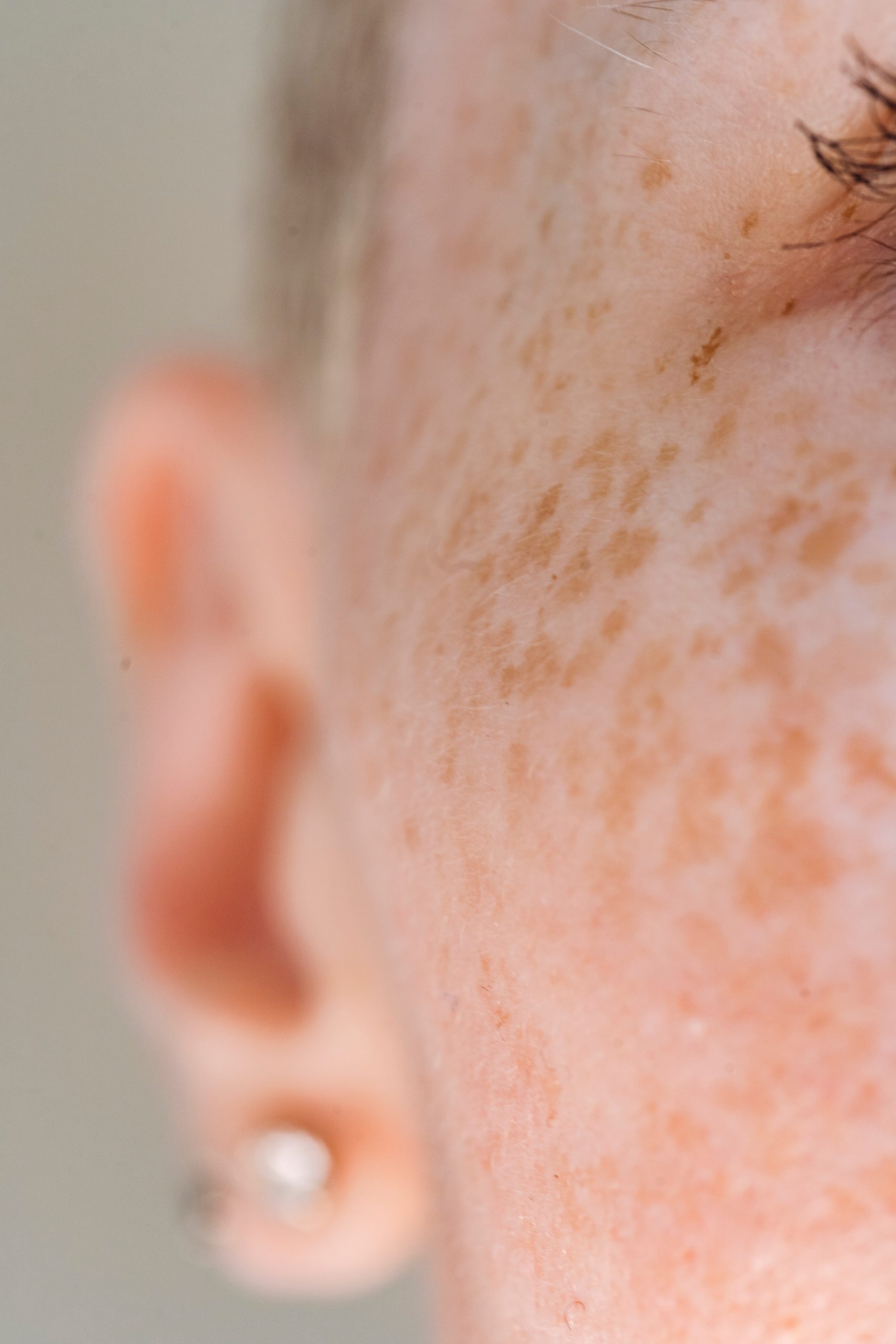Melasma vs Hyperpigmentation: Causes, Symptoms, Treatments
